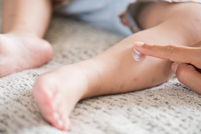 Calamine - Manfaat, Dosis, dan Efek Samping - Alodokter