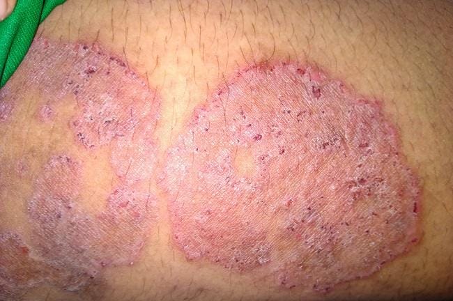 Jamur Kulit - Gejala, penyebab dan mengobati - Alodokter