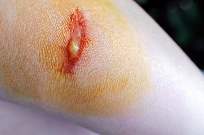 7 Obat Luka Bernanah yang Efektif Mempercepat Penyembuhan - Alodokter