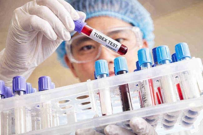 Tes TUBEX, Pemeriksaan Penunjang untuk Mendeteksi Demam Tifoid - Alodokter